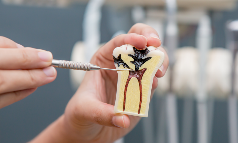 Root Canal | Bridge Street Dental Center - Bridge Street Dental Center